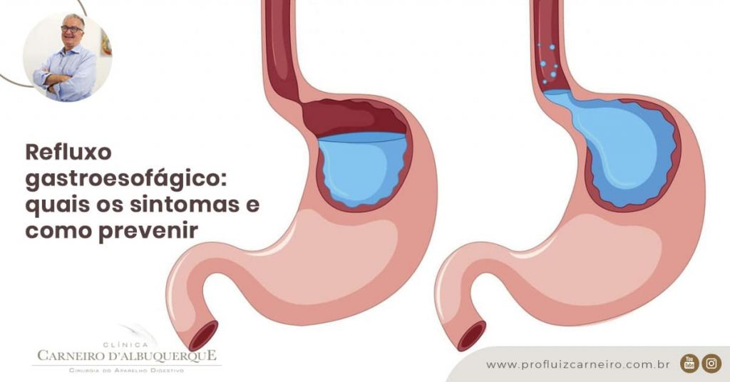 Refluxo Gastroesofágico: Quais Os Sintomas E Como Prevenir - Prof Dr ...