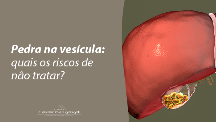 Pedra Na Vesícula: Quais Os Riscos De Não Tratar? - Prof Dr. Luiz Carneiro