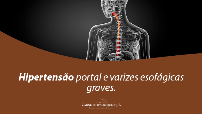 Hipertensão Portal E Varizes Esofágicas Graves - Prof Dr. Luiz Carneiro
