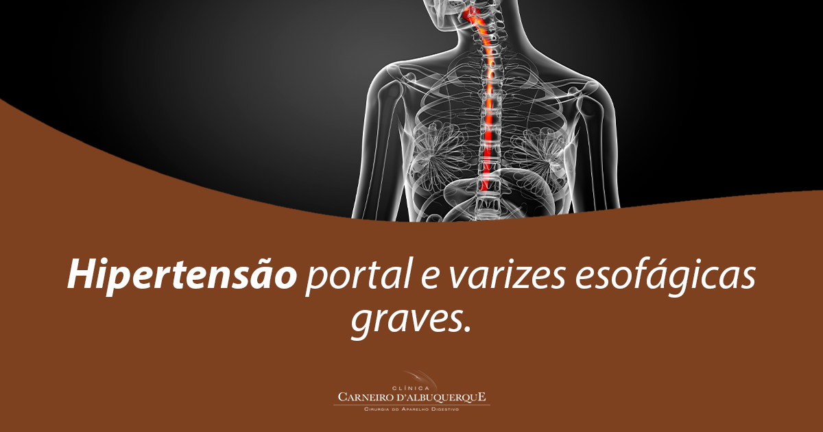 Hipertensão Portal E Varizes Esofágicas Graves - Prof Dr. Luiz Carneiro